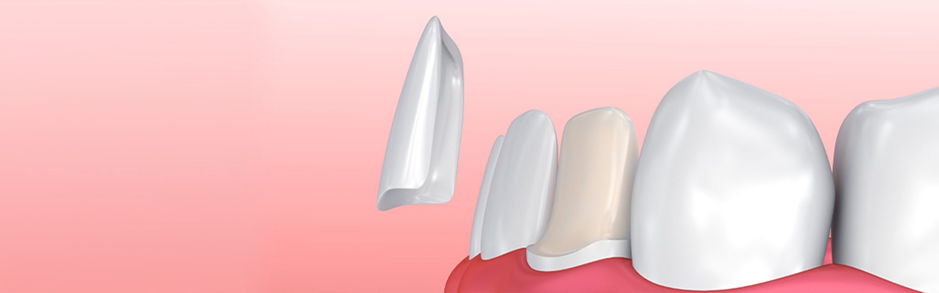 The Impressive Dental Transformation That Veneers Can Give You | Veneer ...